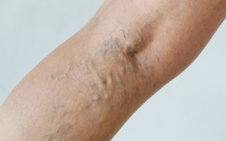 Varis nedir, neden olur, nasıl tedavi edilir? - Uplifers